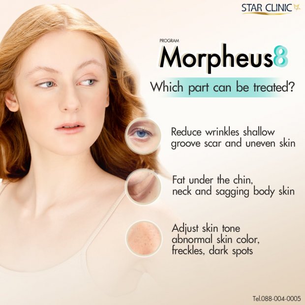 Morpheus8 เทคโนโลยียกกระชับStar Clinic Star Clinic