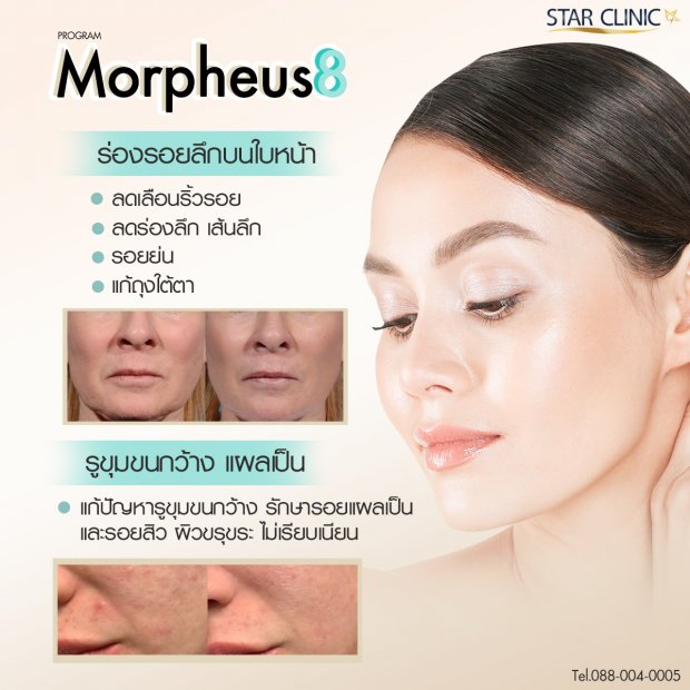 Morpheus8 เทคโนโลยียกกระชับStar Clinic Star Clinic