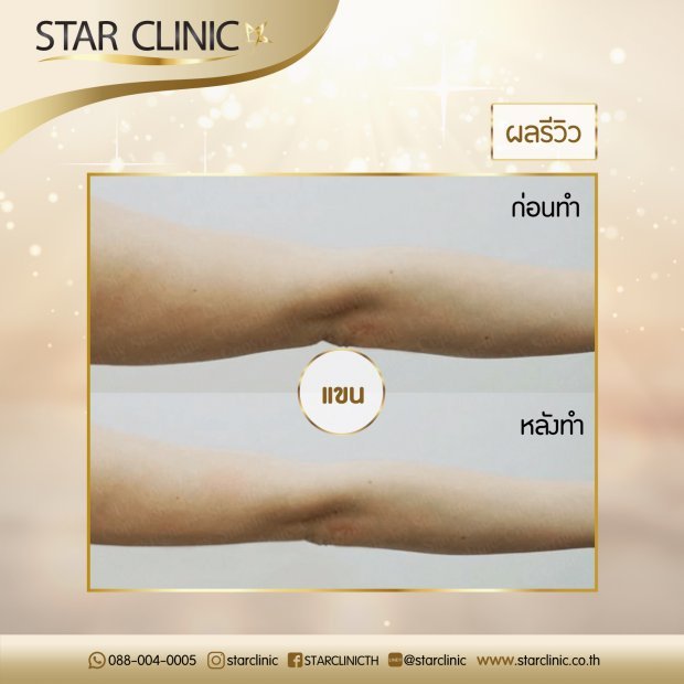 VaserTite (VASER + BodyTite) Star Clinic Star Clinic